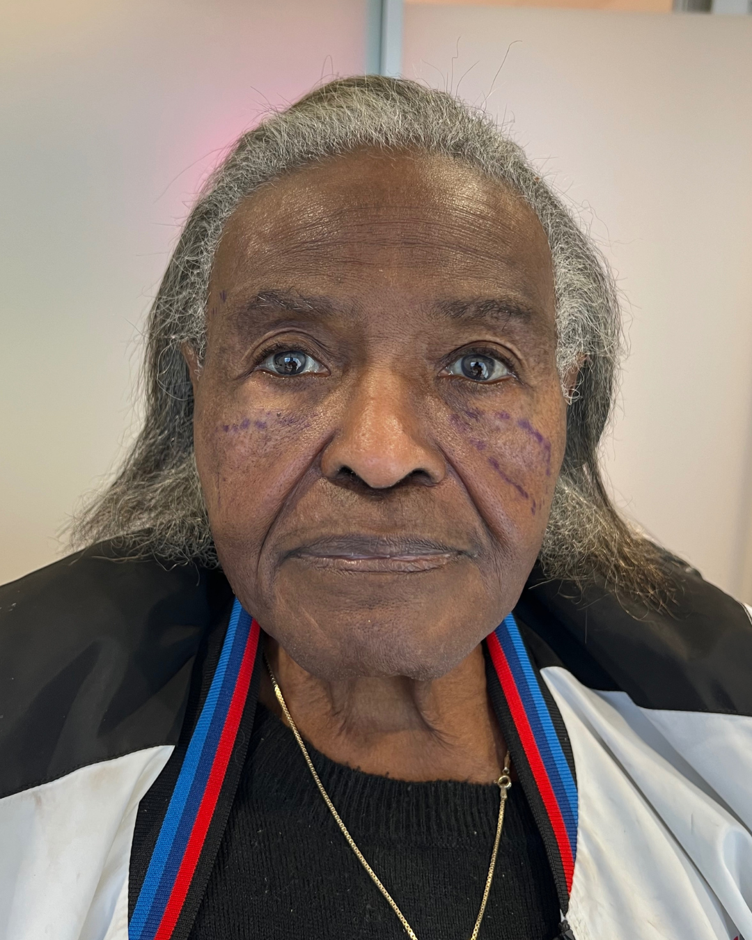 Dermal Fillers Before and After – Davis Facial Plastics